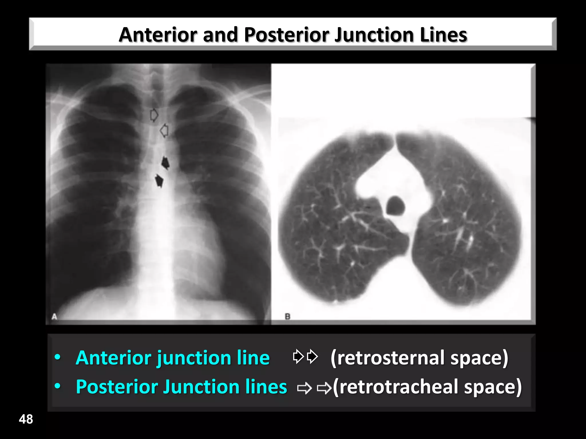 Lines & mediastinal stripes 01 | PPTX