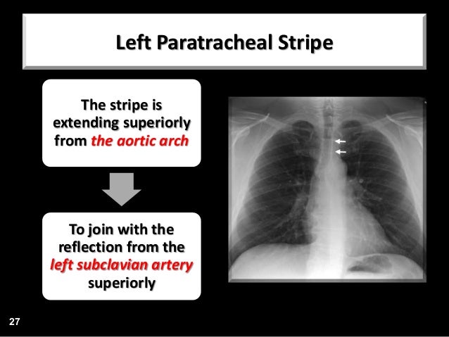 Lines & mediastinal stripes 01