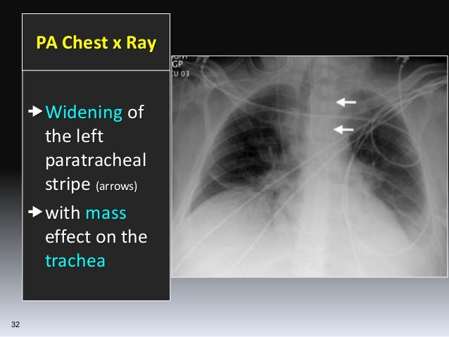 Lines & mediastinal stripes 01