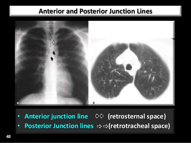 Lines & mediastinal stripes 01