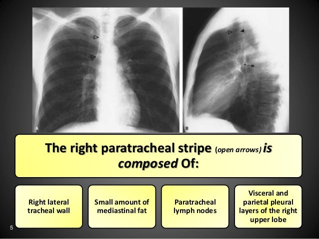 Lines & mediastinal stripes 01