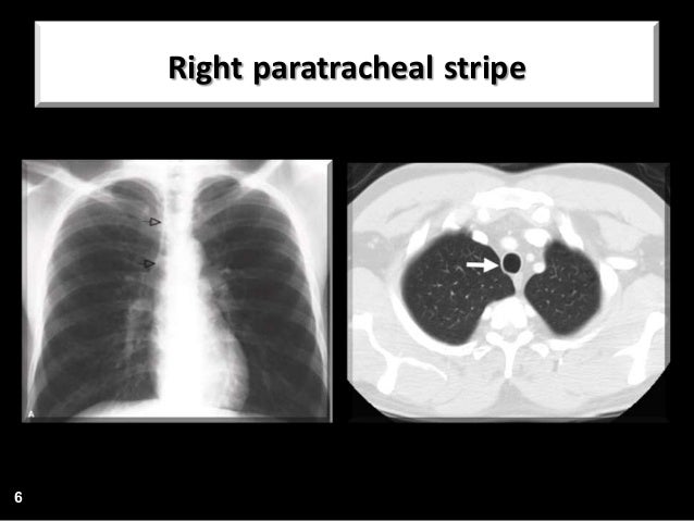 Lines & mediastinal stripes 01
