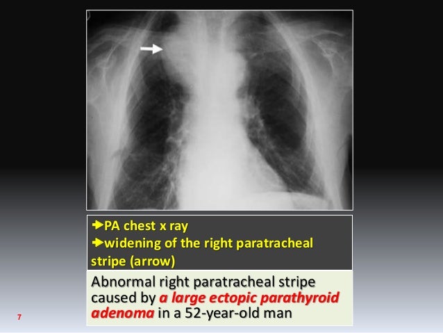 Lines & mediastinal stripes 01