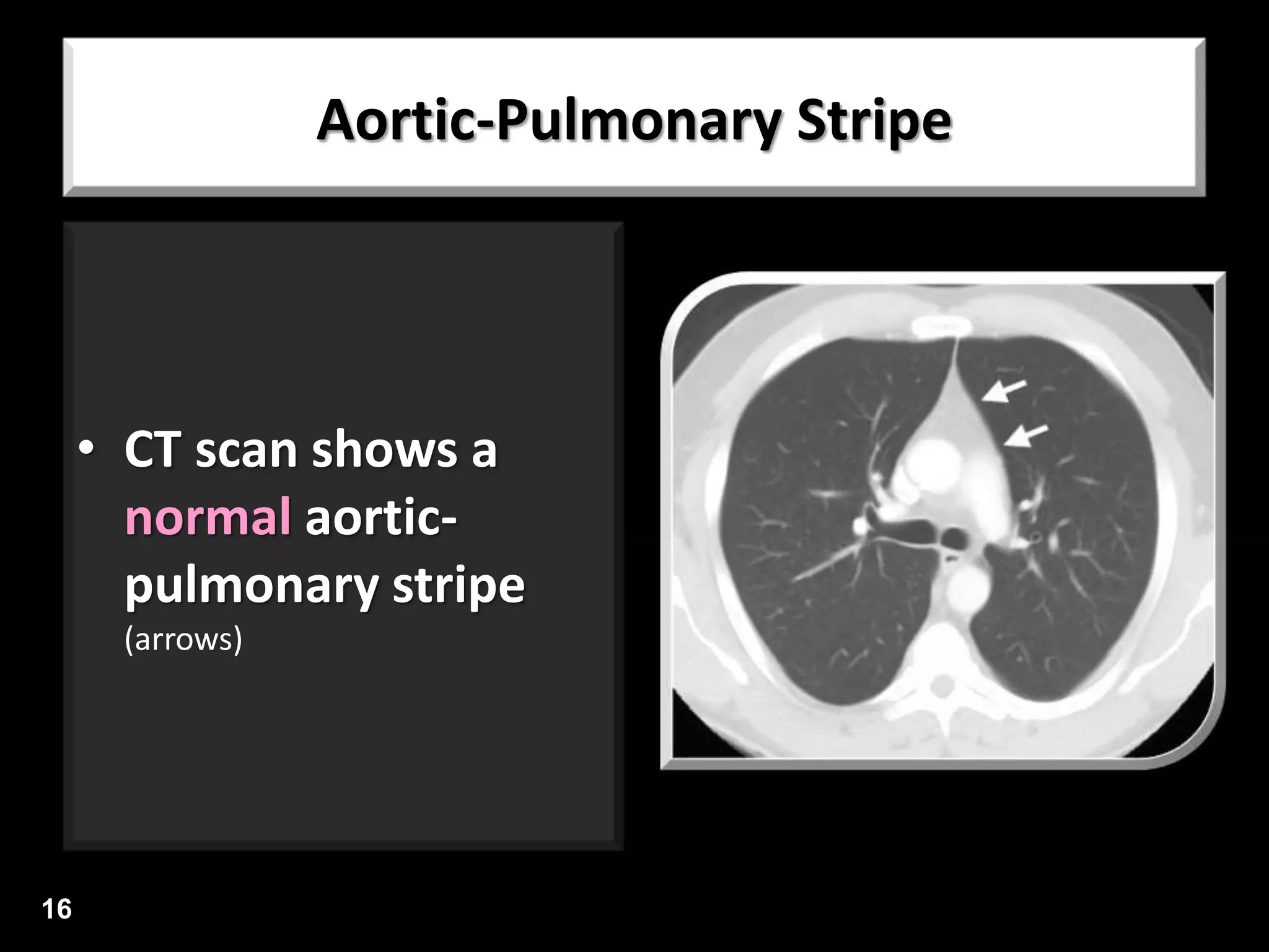 Lines & mediastinal stripes 02 | PPTX