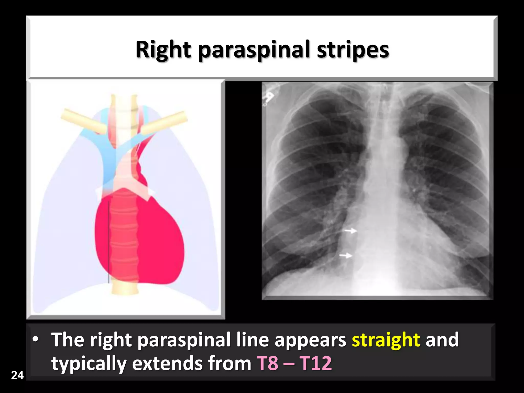 Lines & mediastinal stripes 02 | PPTX