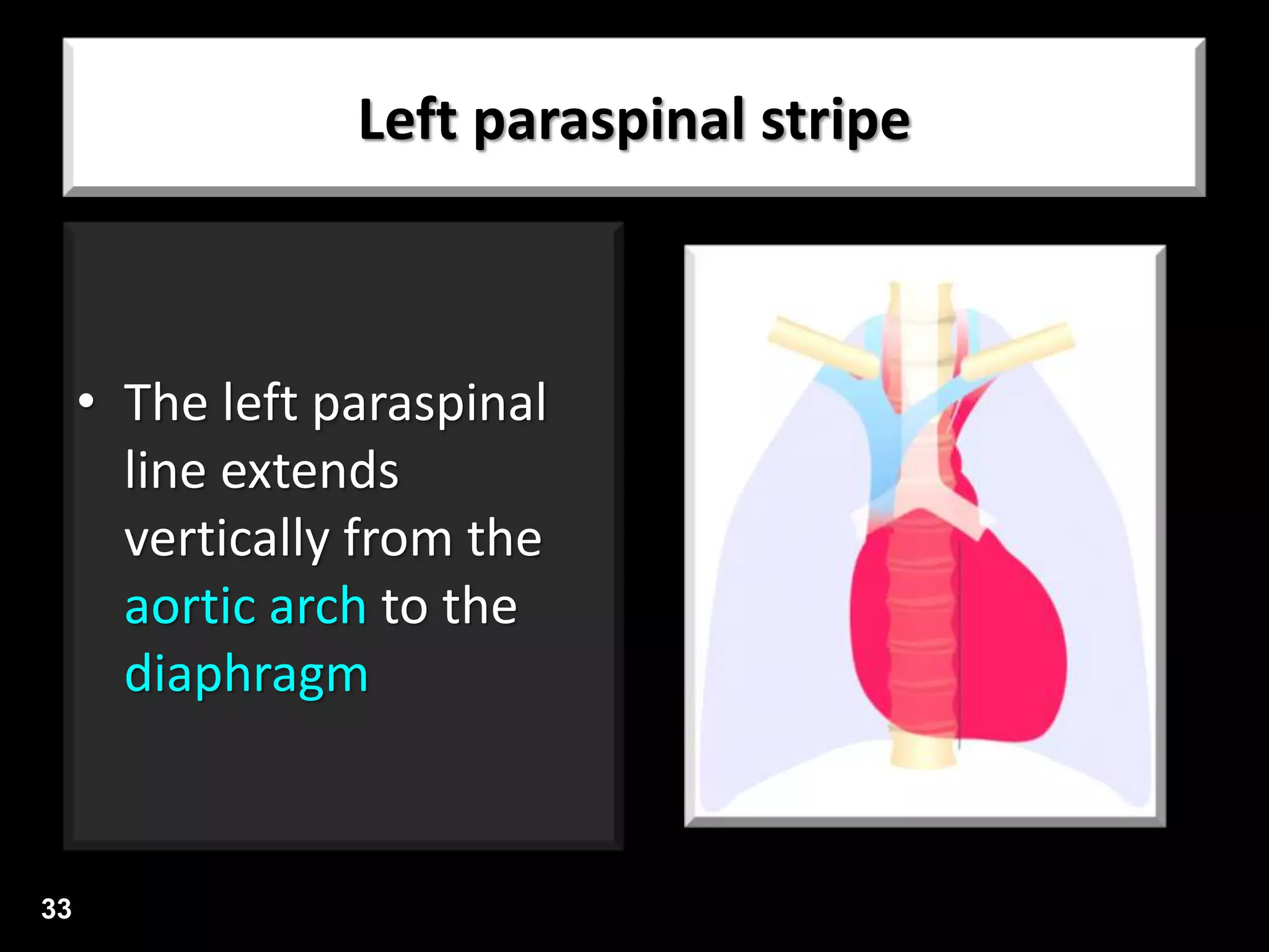 Lines & mediastinal stripes 02 | PPTX