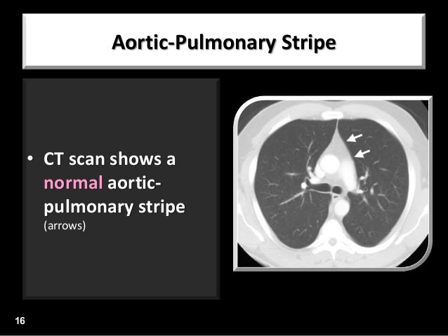 Lines & mediastinal stripes 02