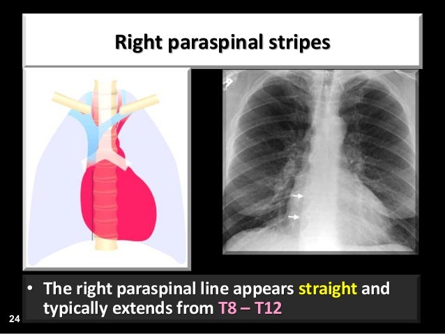 Lines & mediastinal stripes 02