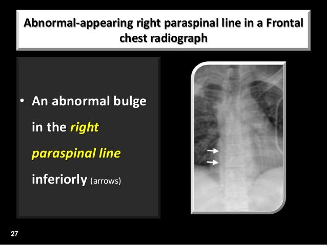 Lines & mediastinal stripes 02