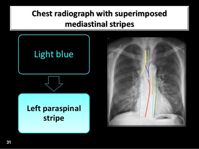 Lines & mediastinal stripes 02