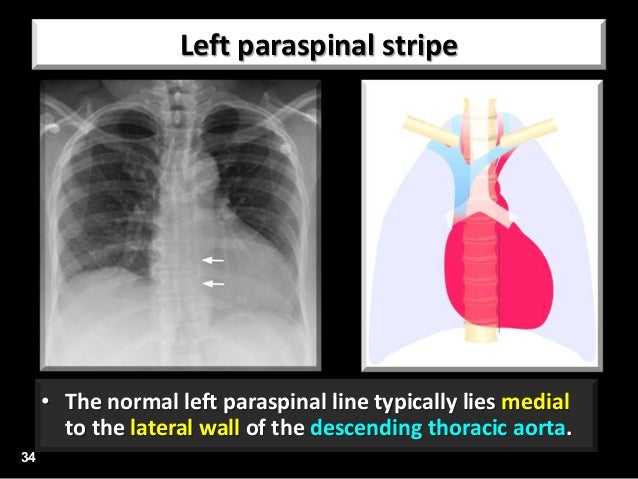 Lines & mediastinal stripes 02