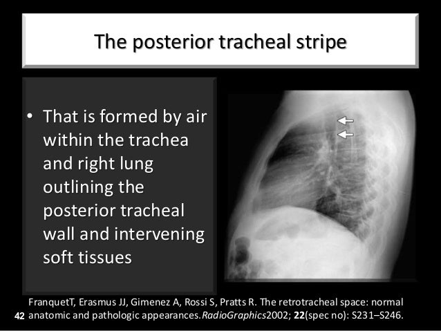 Lines & mediastinal stripes 02