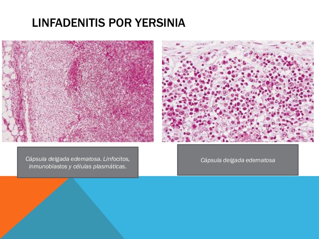 Linfadenitis granulomatosa