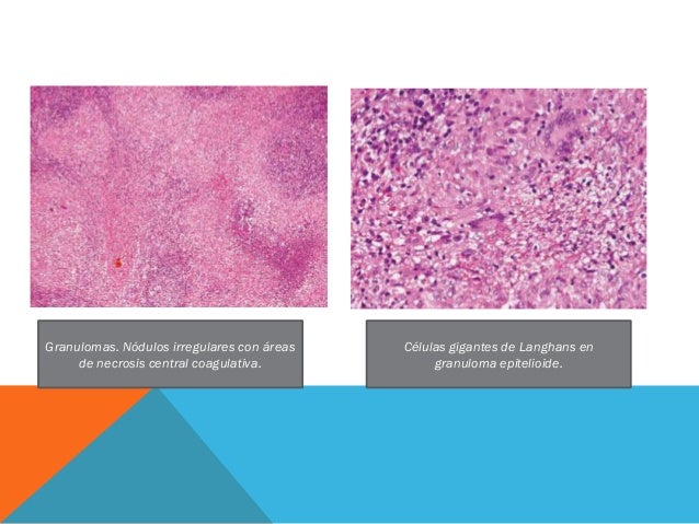 Linfadenitis granulomatosa