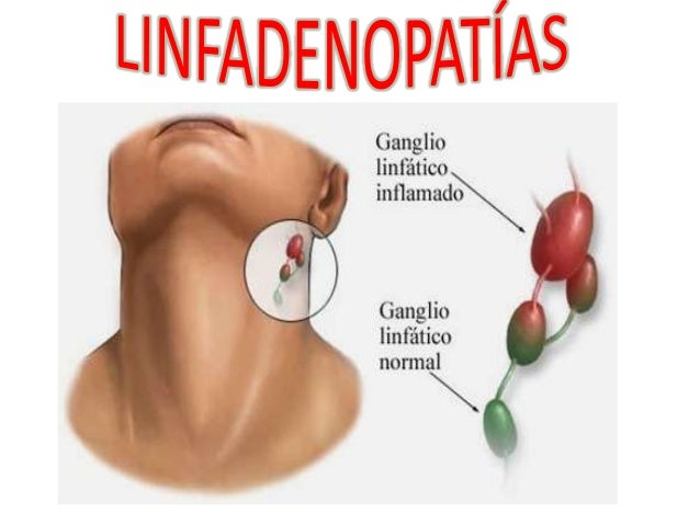 Linfadenopatias