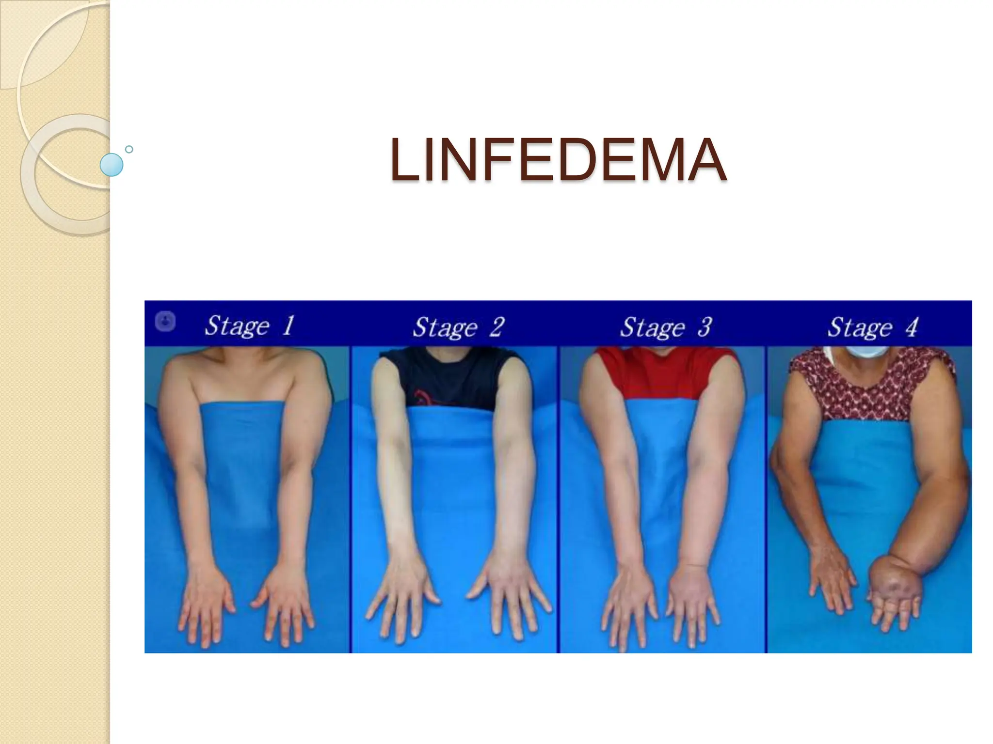 El linfedema es el aumento anormal del liquido rico en proteinas en el ...