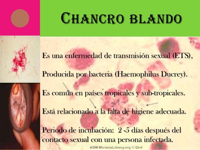 Linfogranuloma venereo