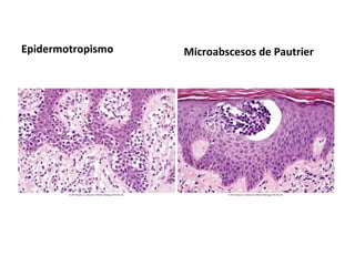 Microabscesos Pautrier