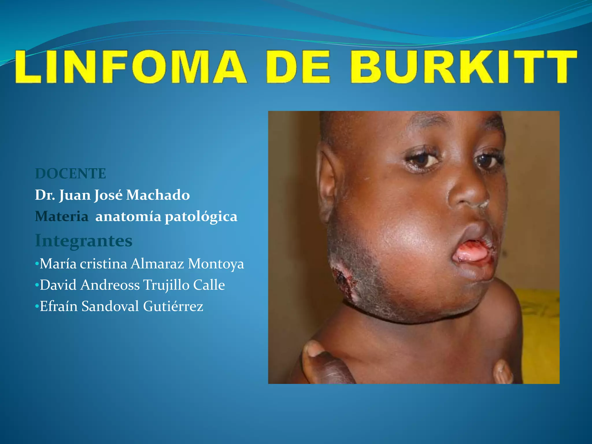 Linfoma de burkitt | PPTX | Cancer | Diseases and Conditions