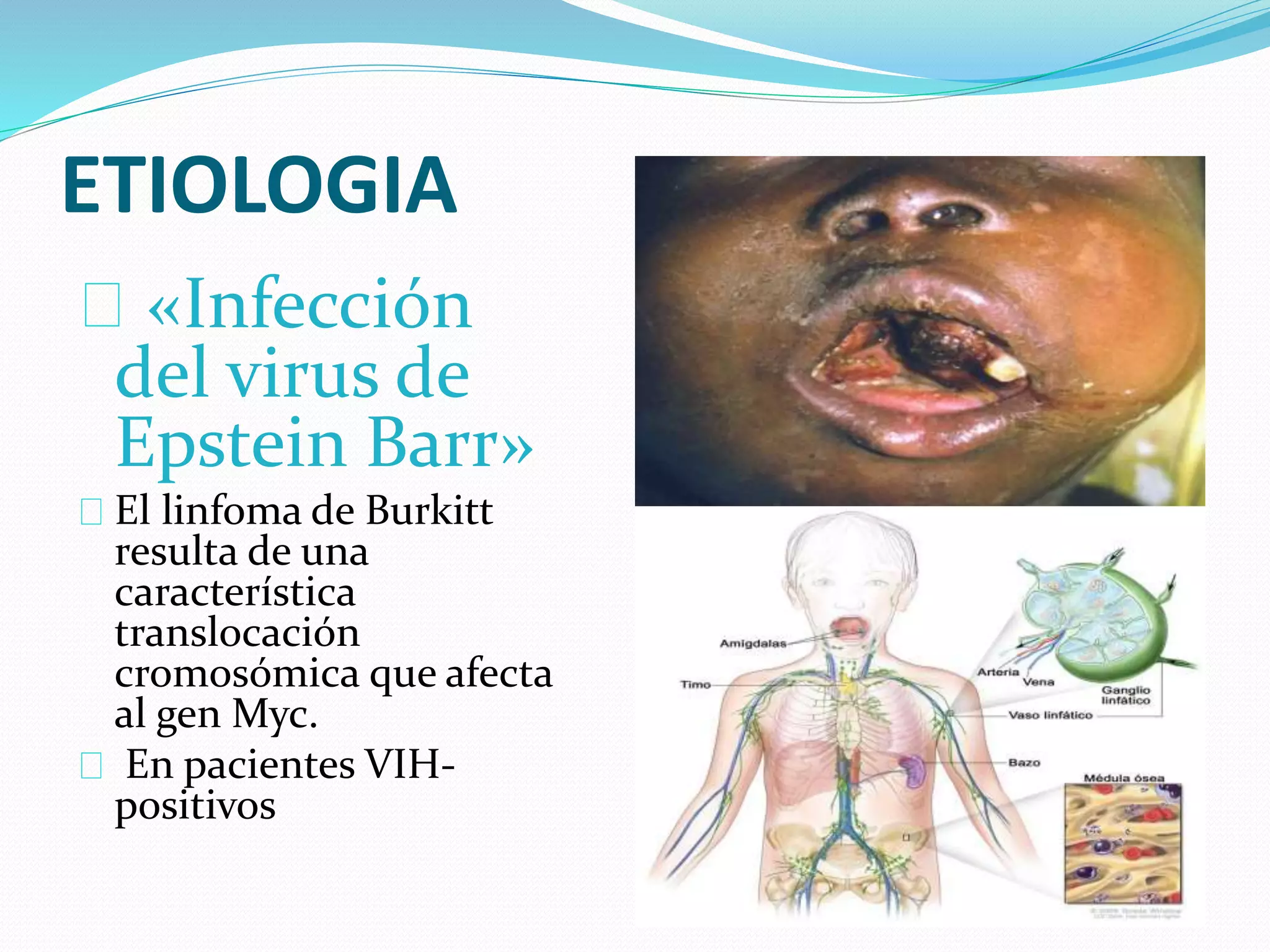 Linfoma de burkitt | PPTX | Cancer | Diseases and Conditions