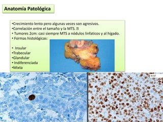 Linfoma gastrointestinal | PPTX