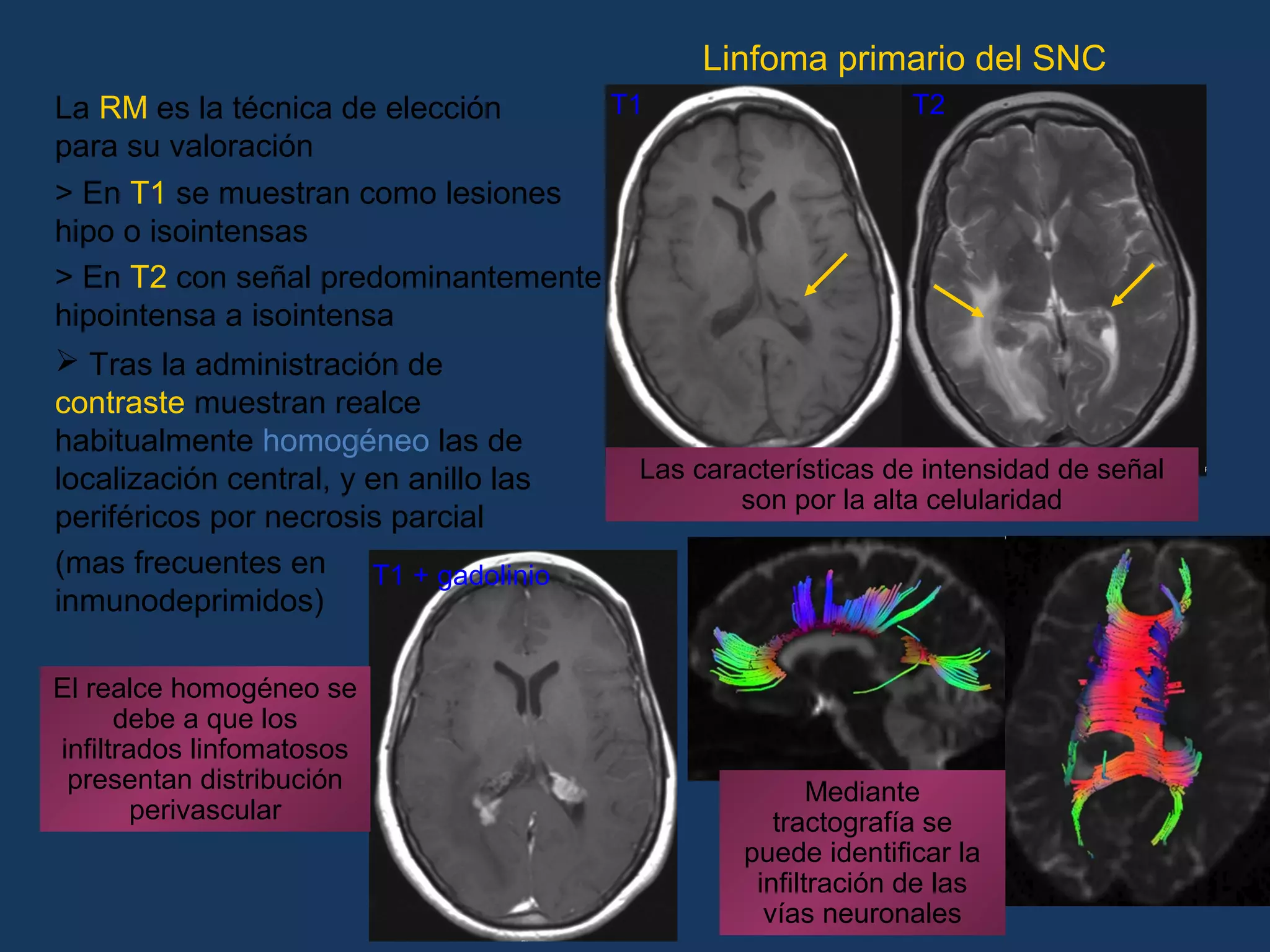LINFOMAS.RADIOLOGIA | PPT