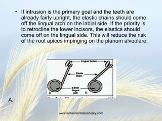 Lingual arch for incisor intrusion. | PPT