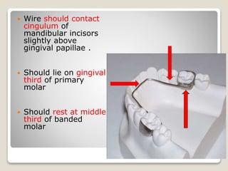 Lingual arch space maintainer | PPTX