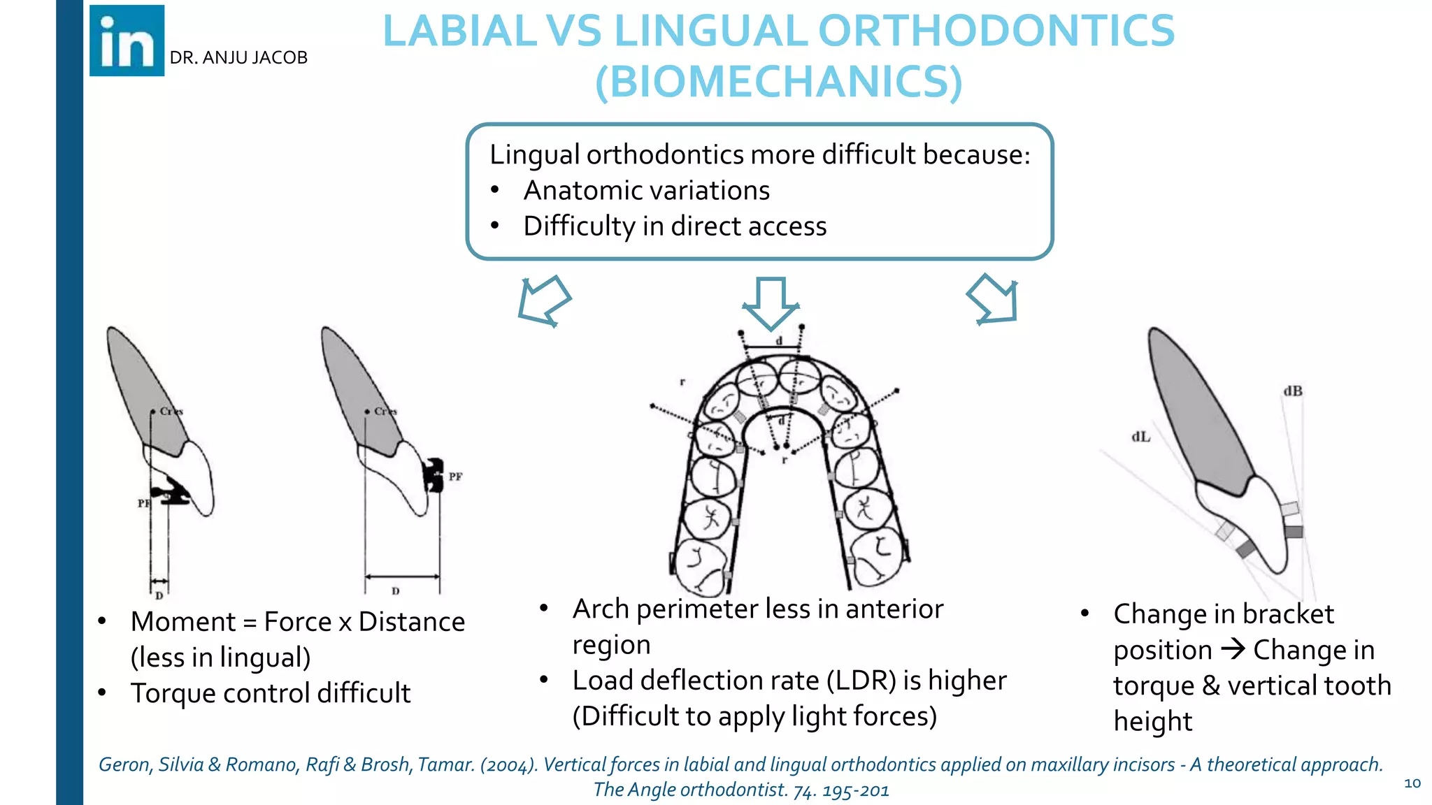 Lingual Orthodontics (Lingual Brackets & Lingual Bonding) | PPTX