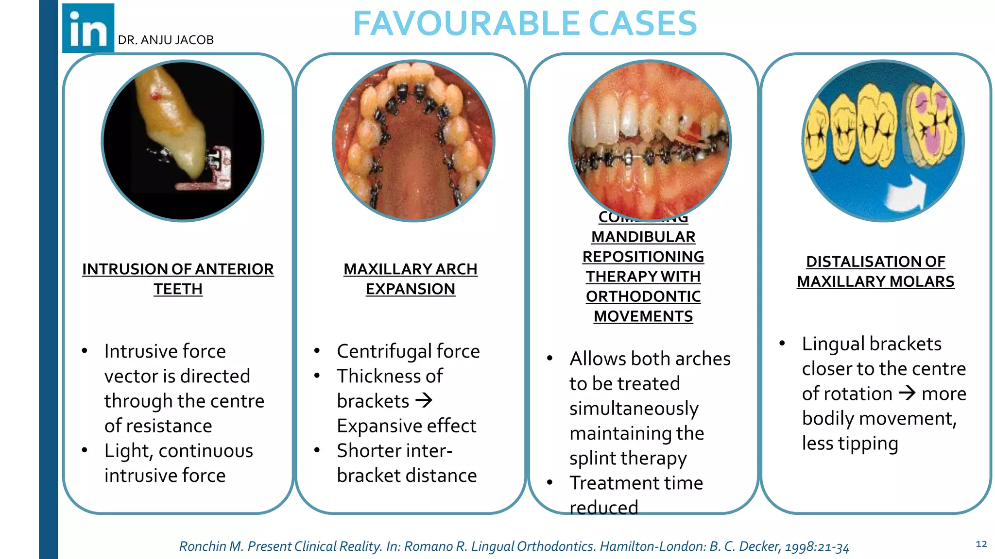 Lingual Orthodontics (Lingual Brackets & Lingual Bonding) | PPTX