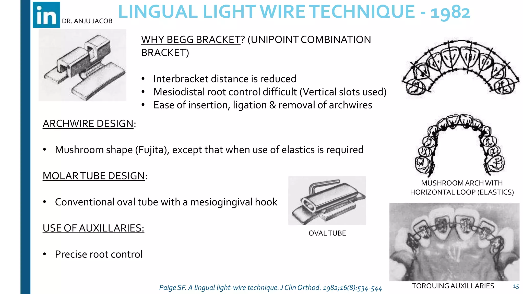 Lingual Orthodontics (Lingual Brackets & Lingual Bonding) | PPTX