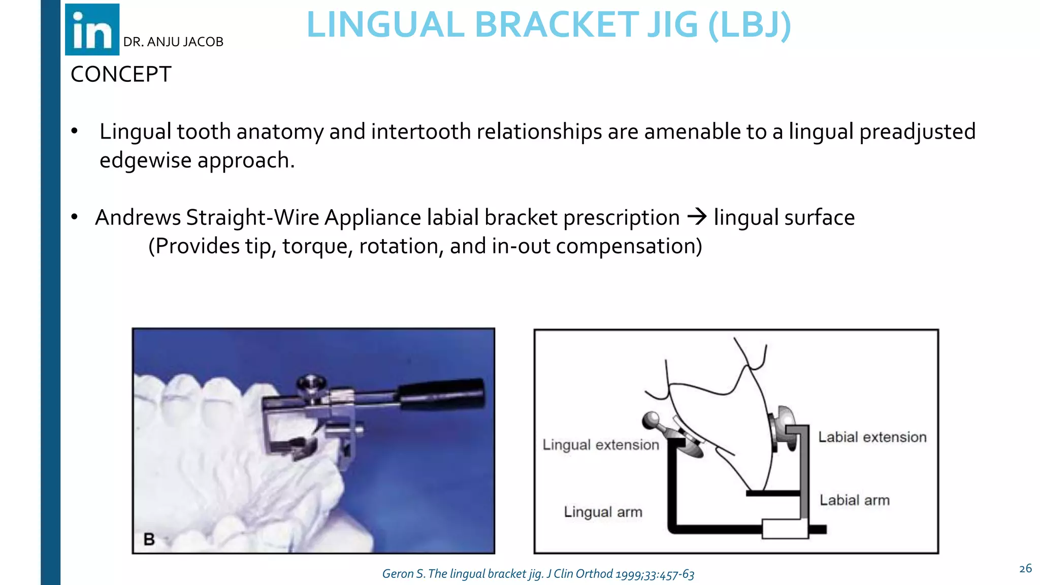 Lingual Orthodontics (Lingual Brackets & Lingual Bonding) | PPTX ...
