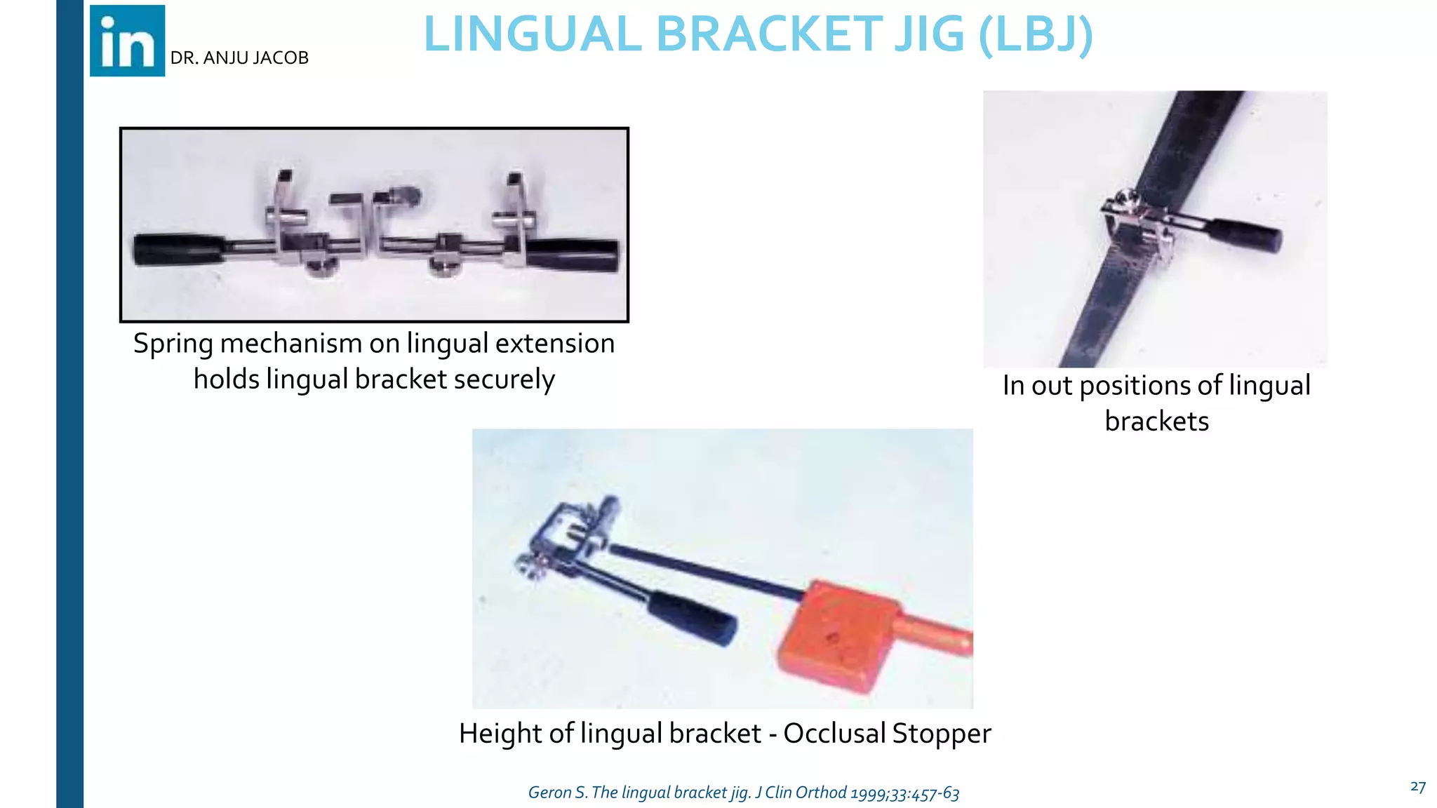 Lingual Orthodontics (Lingual Brackets & Lingual Bonding) | PPTX