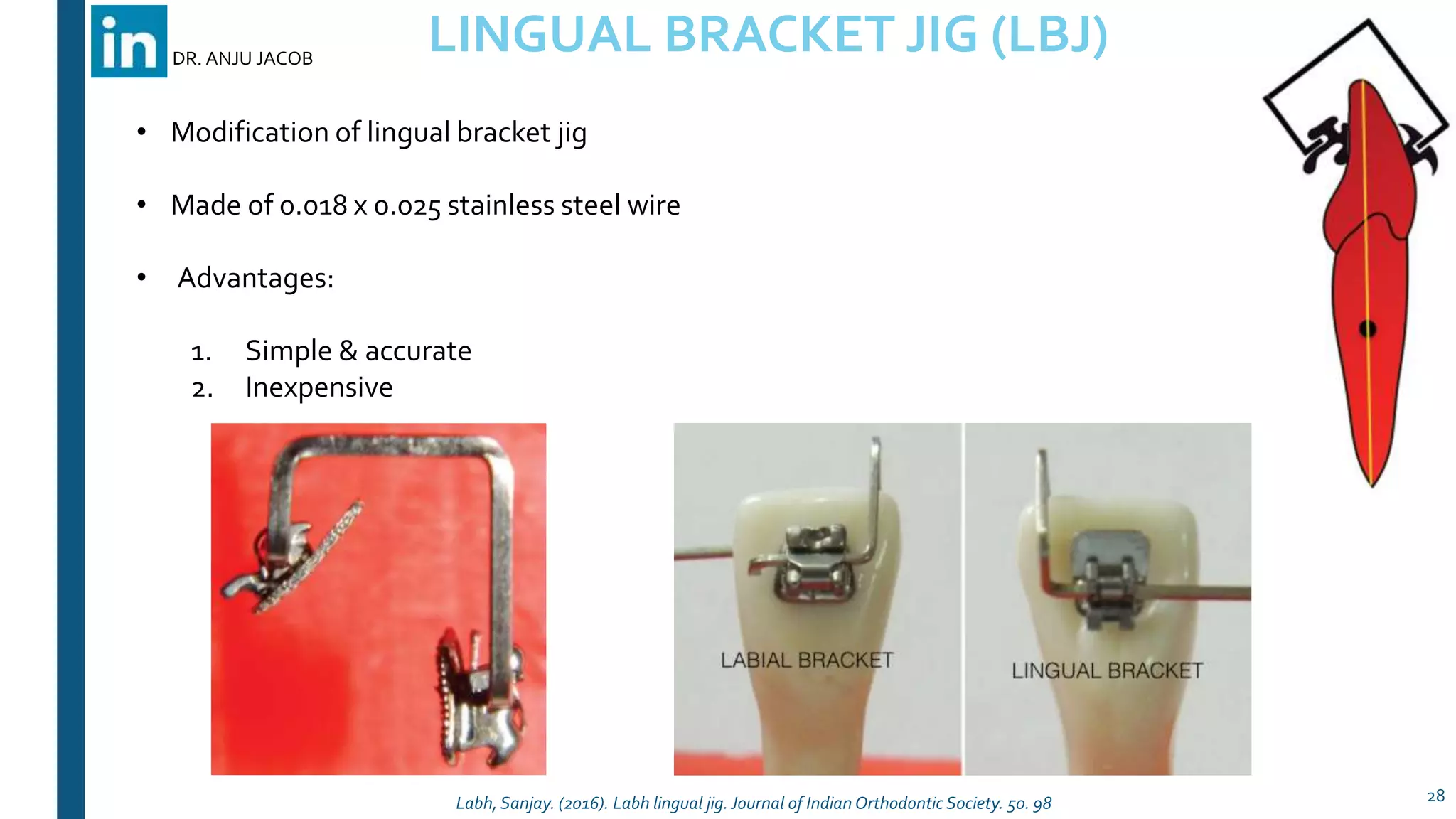 Lingual Orthodontics (Lingual Brackets & Lingual Bonding) | PPTX