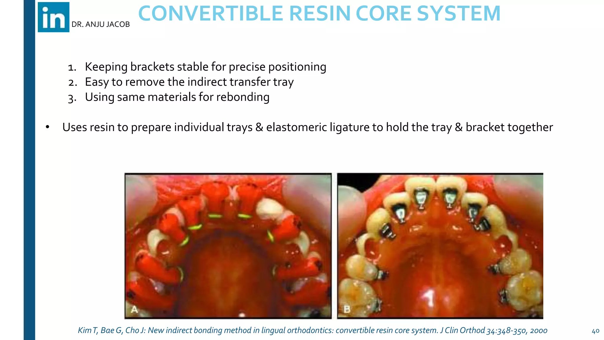 Lingual Orthodontics (Lingual Brackets & Lingual Bonding) | PPTX