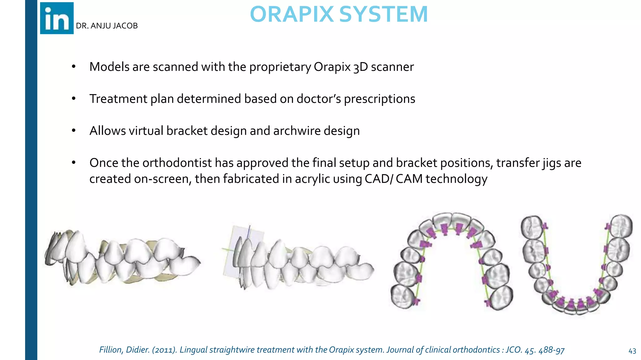 Lingual Orthodontics (Lingual Brackets & Lingual Bonding) | PPTX