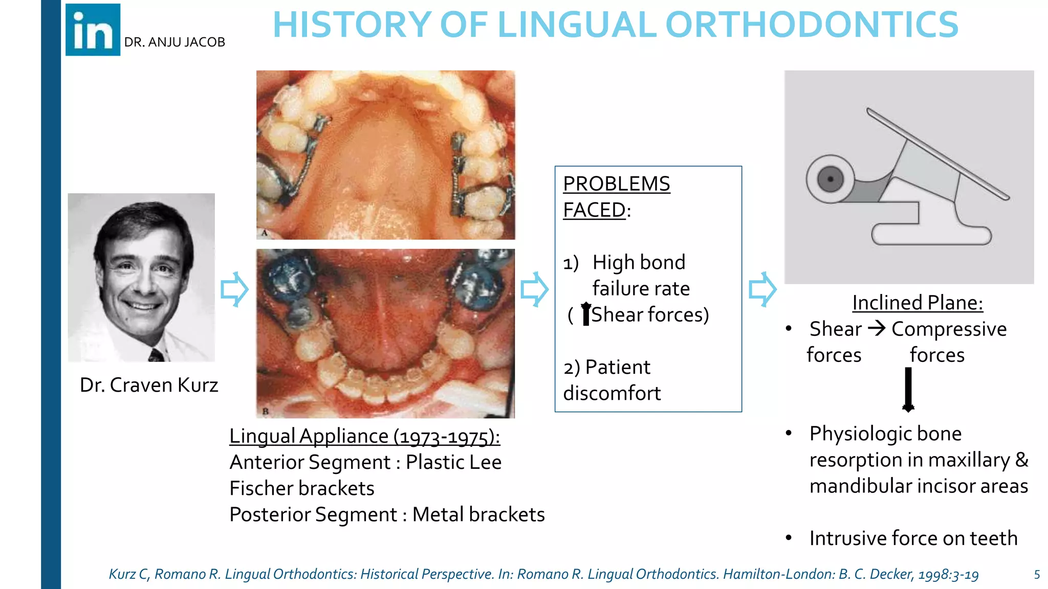 Lingual Orthodontics (Lingual Brackets & Lingual Bonding) | PPTX