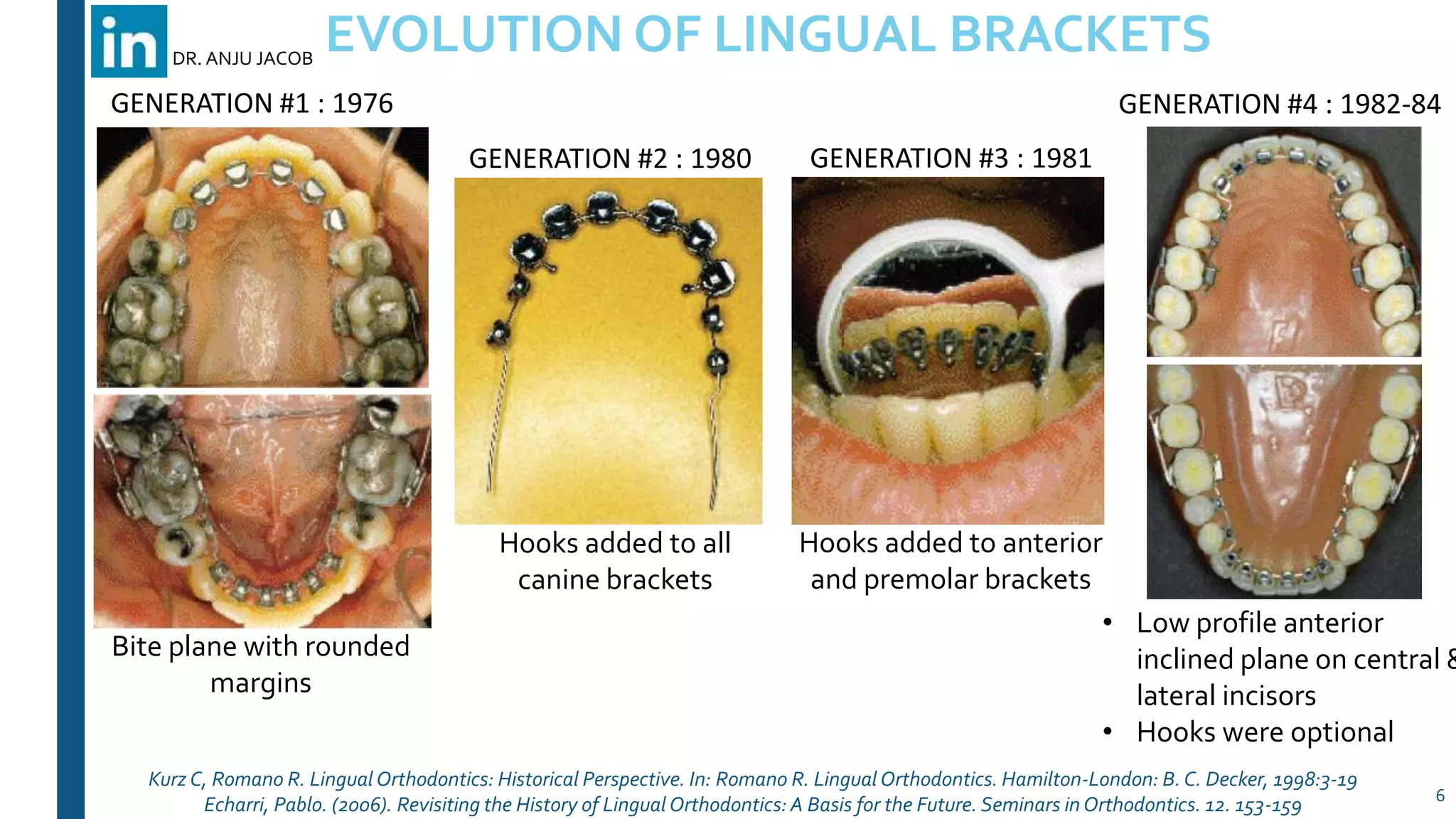 Lingual Orthodontics (Lingual Brackets & Lingual Bonding) | PPTX