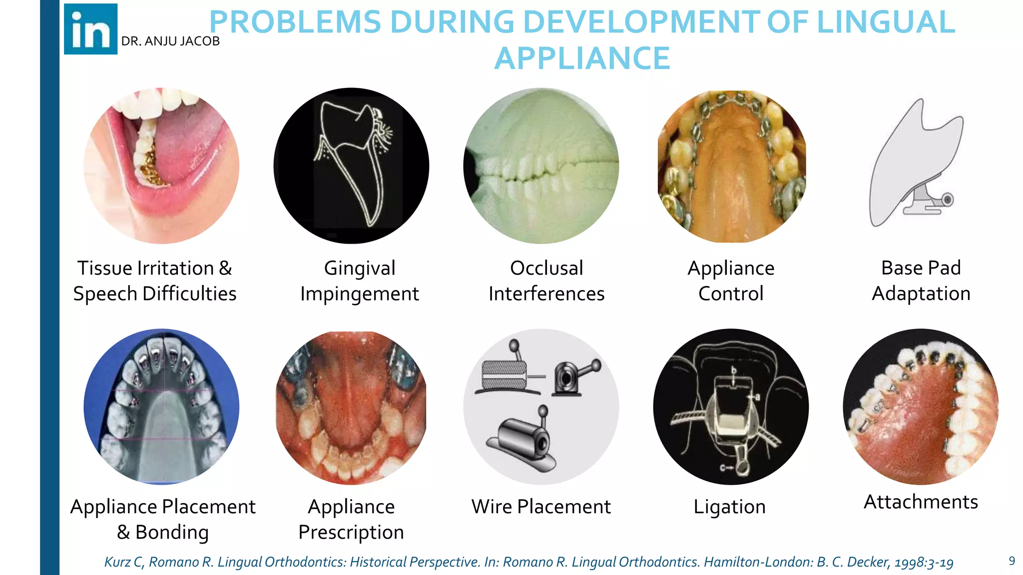 Lingual Orthodontics (Lingual Brackets & Lingual Bonding) | PPTX