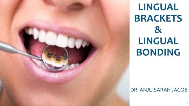 Lingual Orthodontics (Lingual Brackets & Lingual Bonding) | PPTX ...