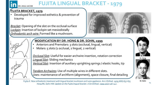 Lingual Orthodontics (Lingual Brackets & Lingual Bonding) | PPTX ...