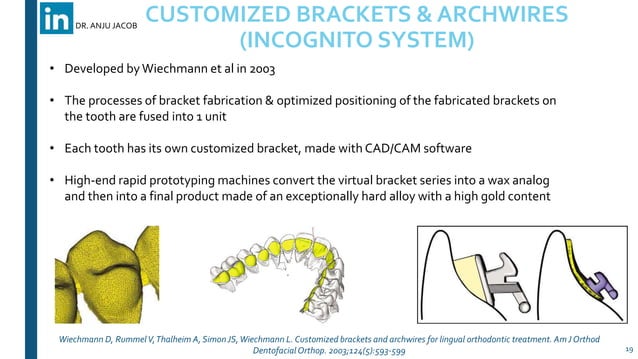Lingual Orthodontics (Lingual Brackets & Lingual Bonding) | PPTX ...