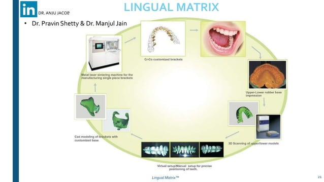 Lingual Orthodontics (Lingual Brackets & Lingual Bonding) | PPTX ...