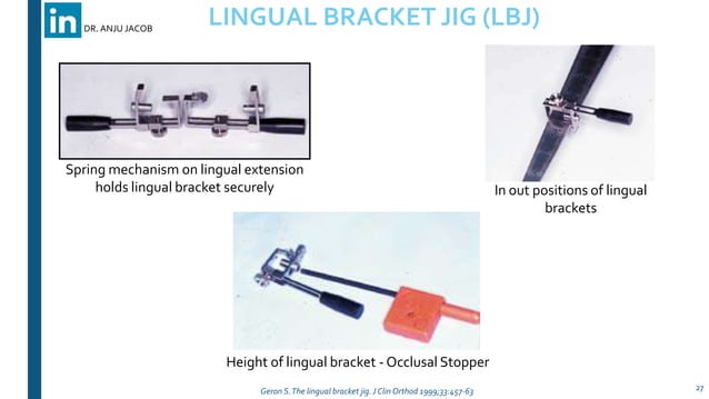 Lingual Orthodontics (Lingual Brackets & Lingual Bonding) | PPTX ...