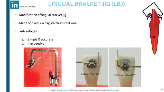 Lingual Orthodontics (Lingual Brackets & Lingual Bonding) | PPTX ...