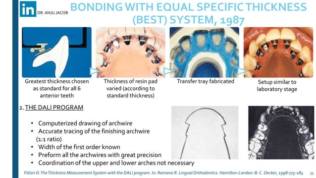 Lingual Orthodontics (Lingual Brackets & Lingual Bonding) | PPTX ...