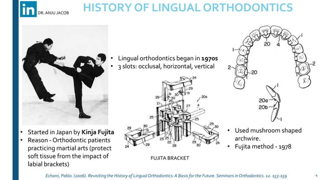 Lingual Orthodontics (Lingual Brackets & Lingual Bonding) | PPTX ...