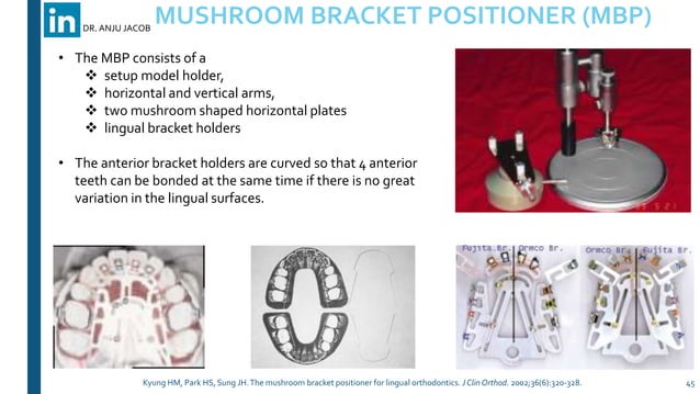 Lingual Orthodontics (Lingual Brackets & Lingual Bonding) | PPTX ...