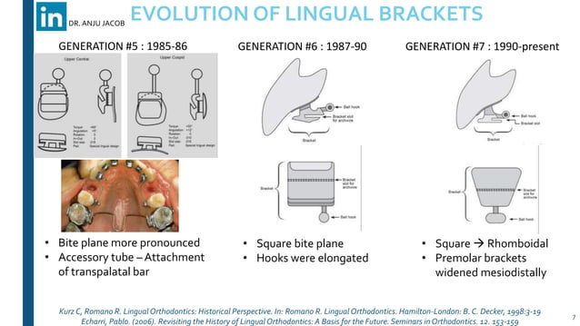 Lingual Orthodontics (Lingual Brackets & Lingual Bonding) | PPTX ...