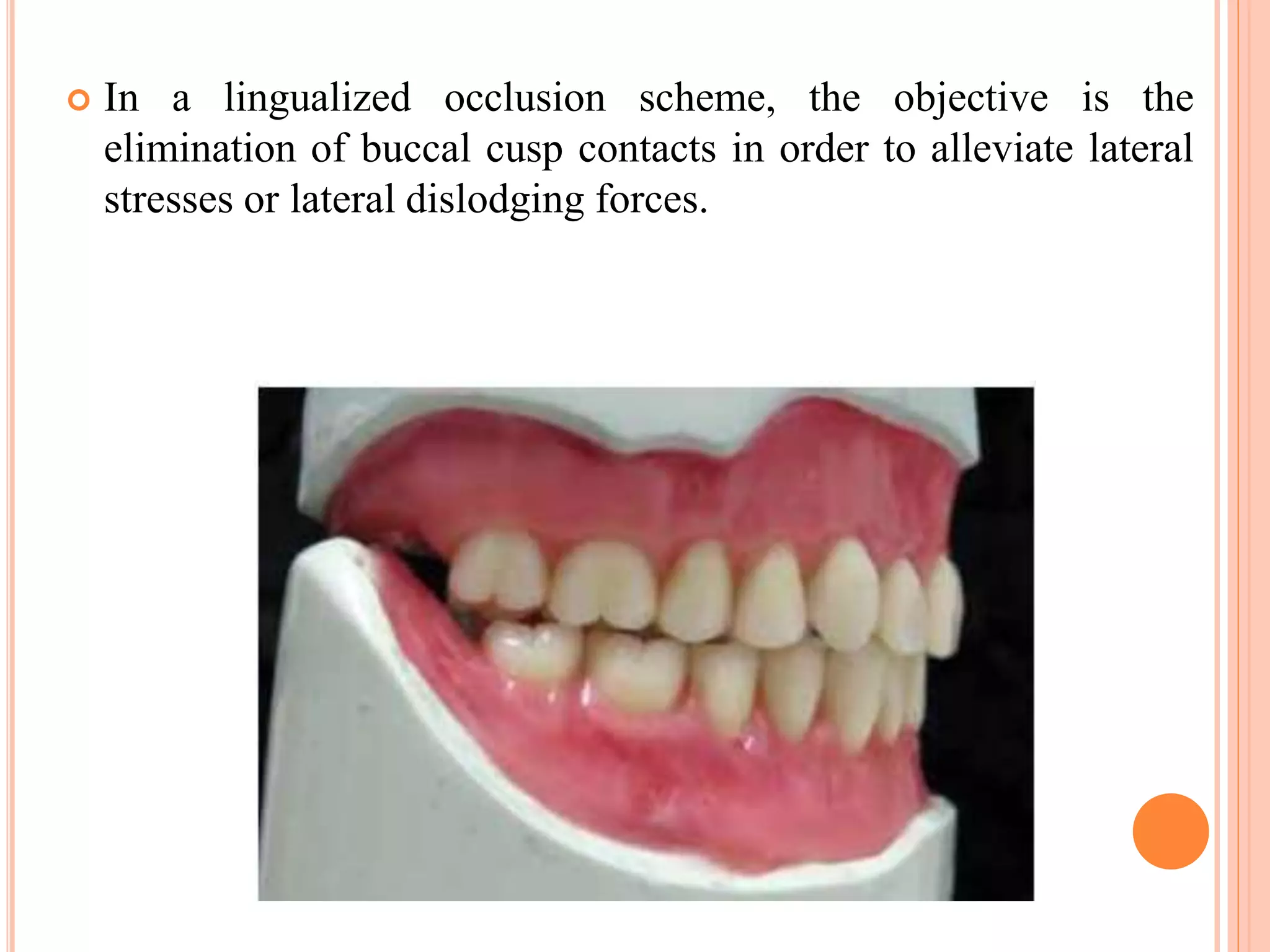 Lingualised occlusion revisited | PPTX